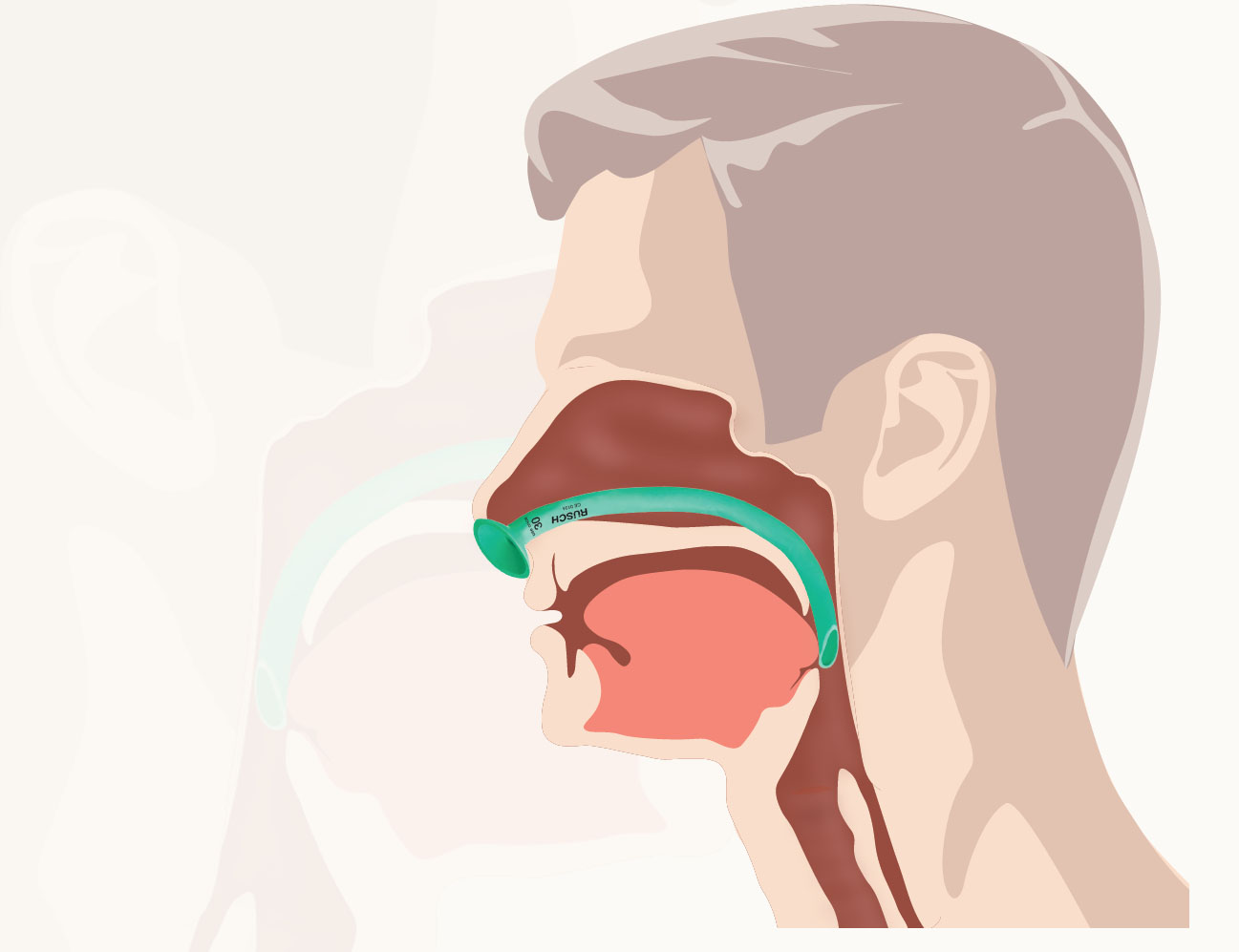 Nasal airway - anlæggelse og udmåling - Fagligt Forum for Akutsygepleje ...